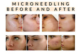 Microneedling Pen Wireless Electric Derma Wand with 6 Pieces Replaceme ...